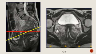 Pelvic Mri Procedure