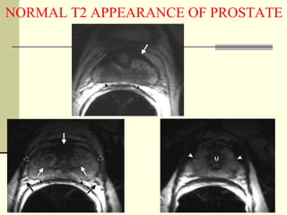 Mri prostate | PPTX