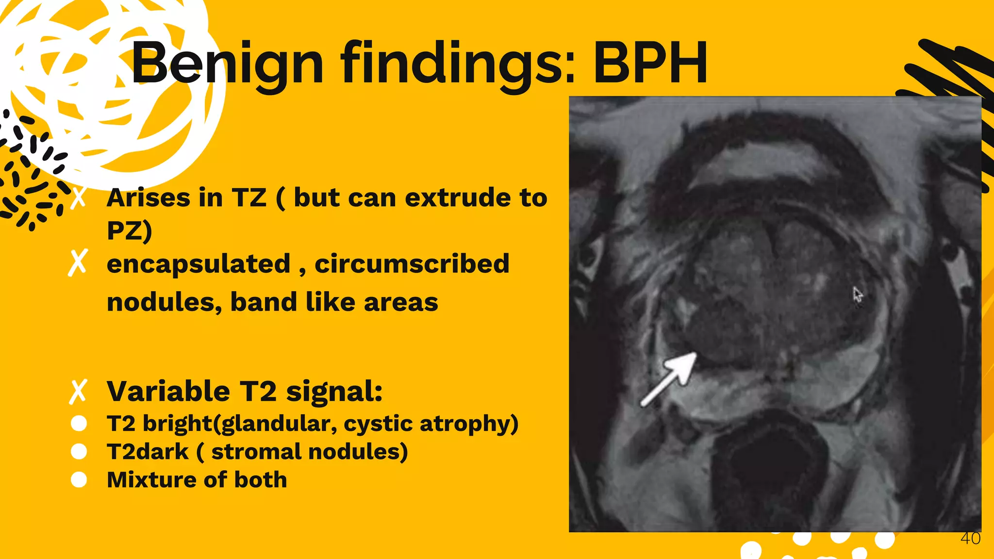 Mri prostate | PPTX