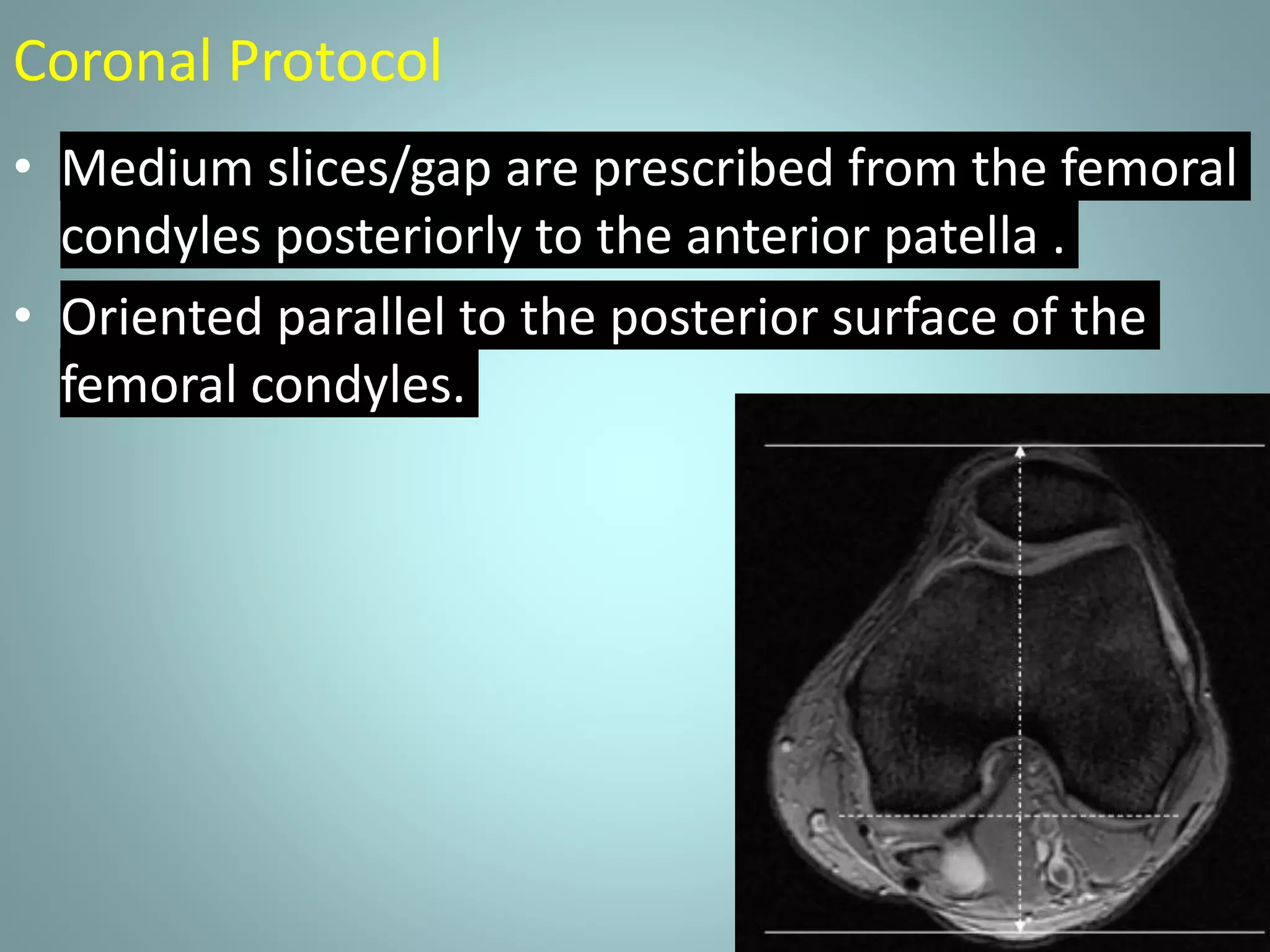 MRI shoulder and knee- Anatomy, Scan Planning & Its Techniques | PPTX