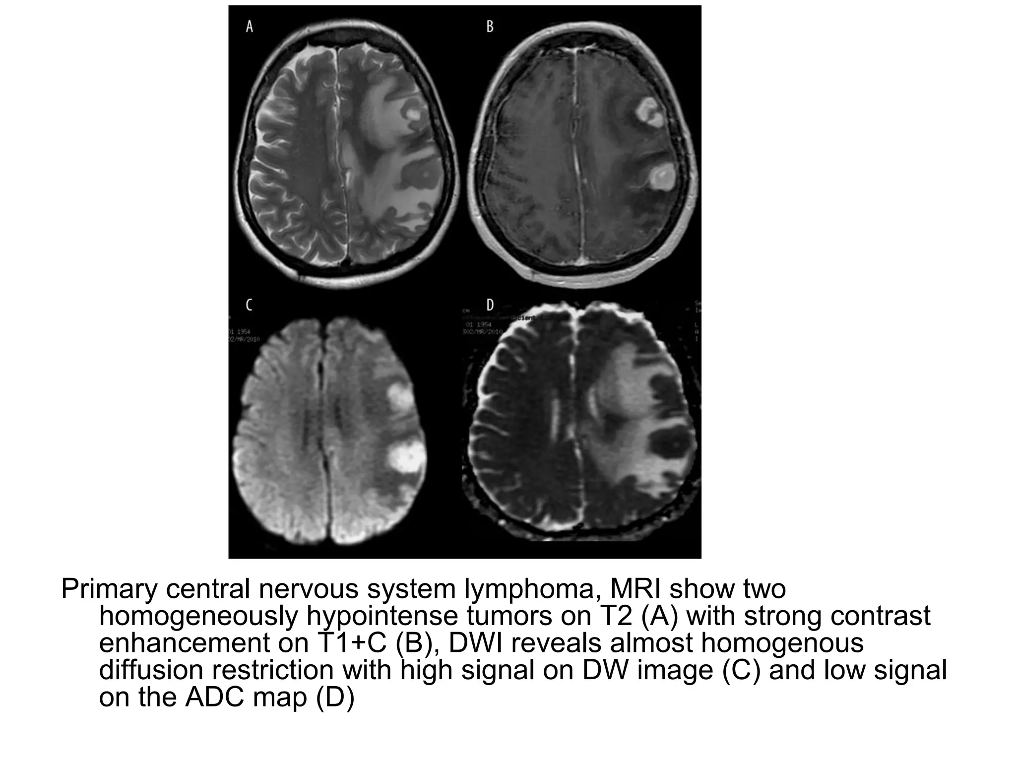 MRI Sequences in Neuroradiology | PPT