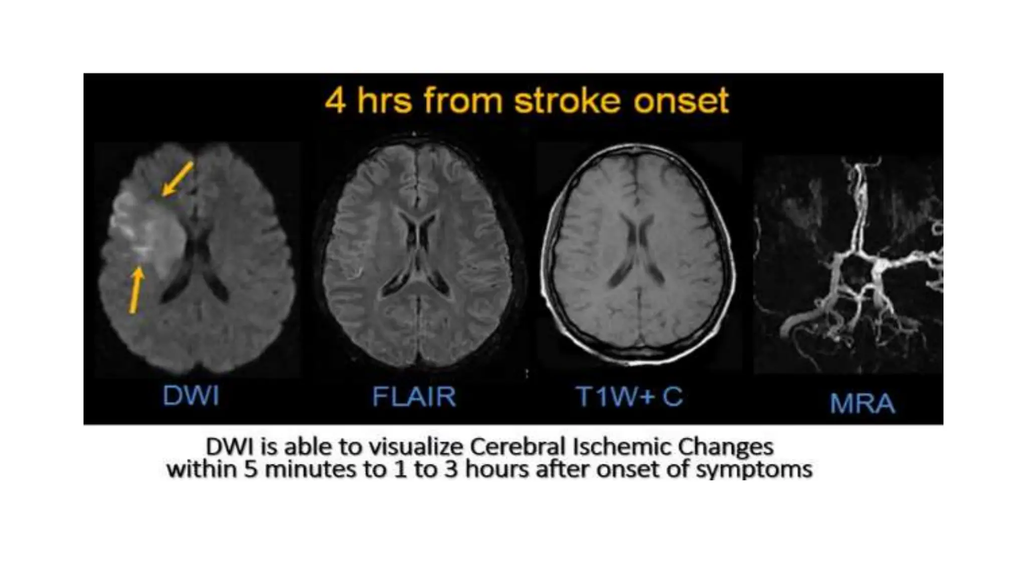 Value of MRI SEQUENCES in Stroke Imaging | PPTX