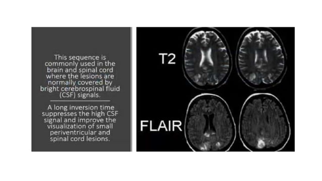 Value of MRI SEQUENCES in Stroke Imaging | PPT