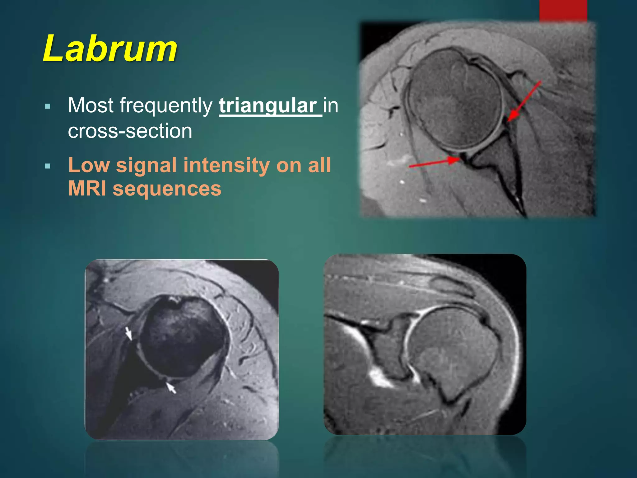 MRI of the shoulder | PPTX