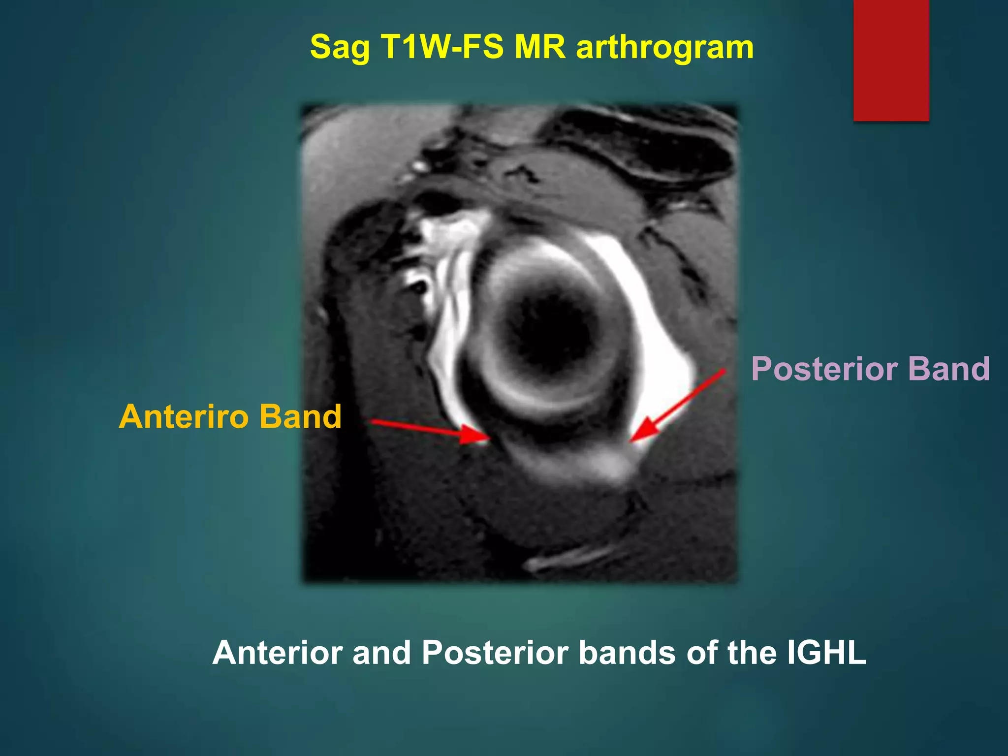 MRI of the shoulder | PPTX