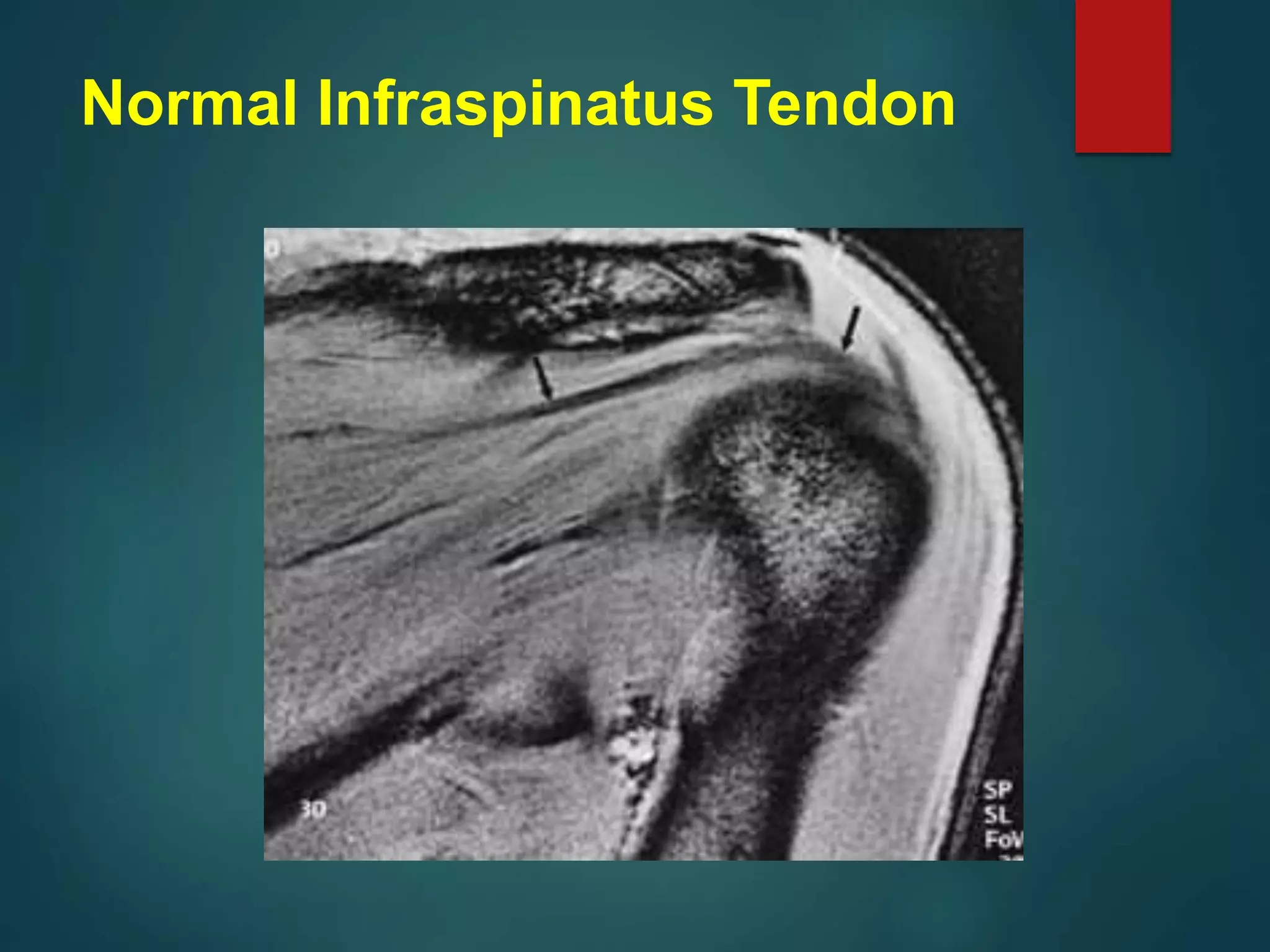 MRI of the shoulder | PPTX