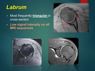 MRI of the shoulder | PPTX