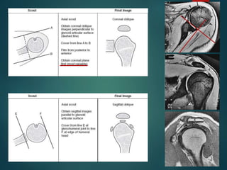 MRI of the shoulder | PPTX