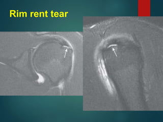 MRI of the shoulder | PPTX
