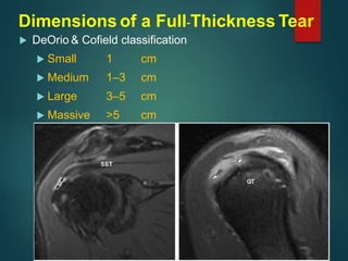 MRI of the shoulder | PPTX