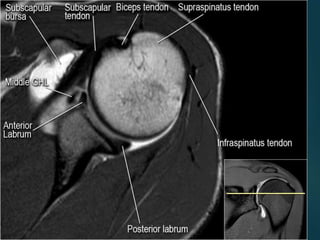 Mri Shoulder Bursitis