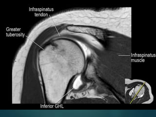 Shoulder Mri Without Contrast