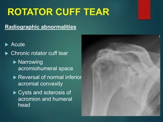 Rotator Cuff Tear X Ray