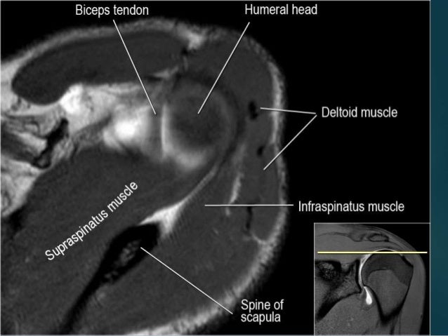 MRI of the shoulder