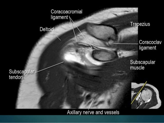 MRI of the shoulder