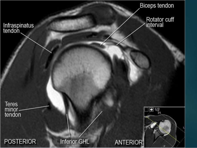 MRI of the shoulder