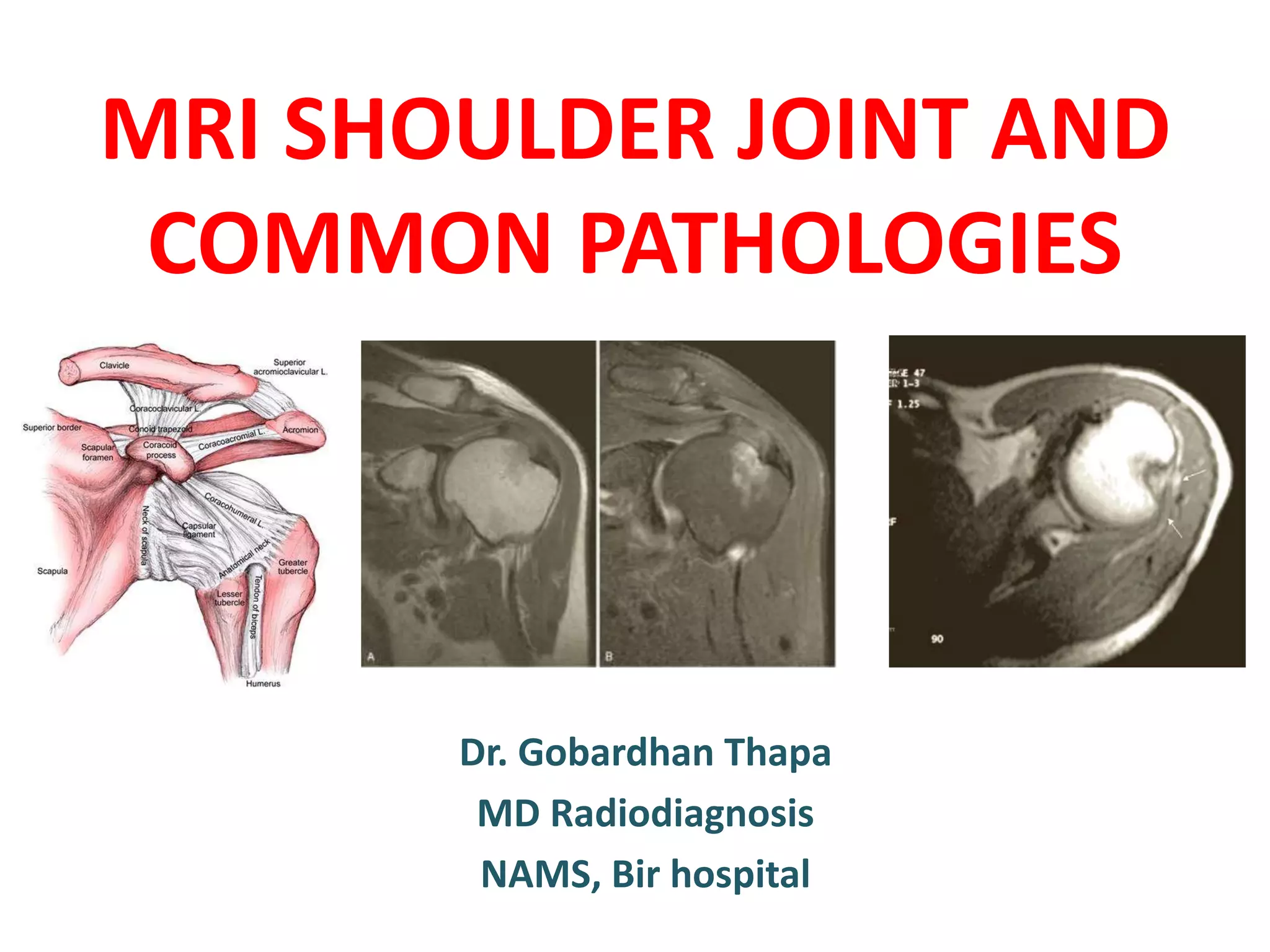 Mri shoulder joint with common pathologies | PPTX