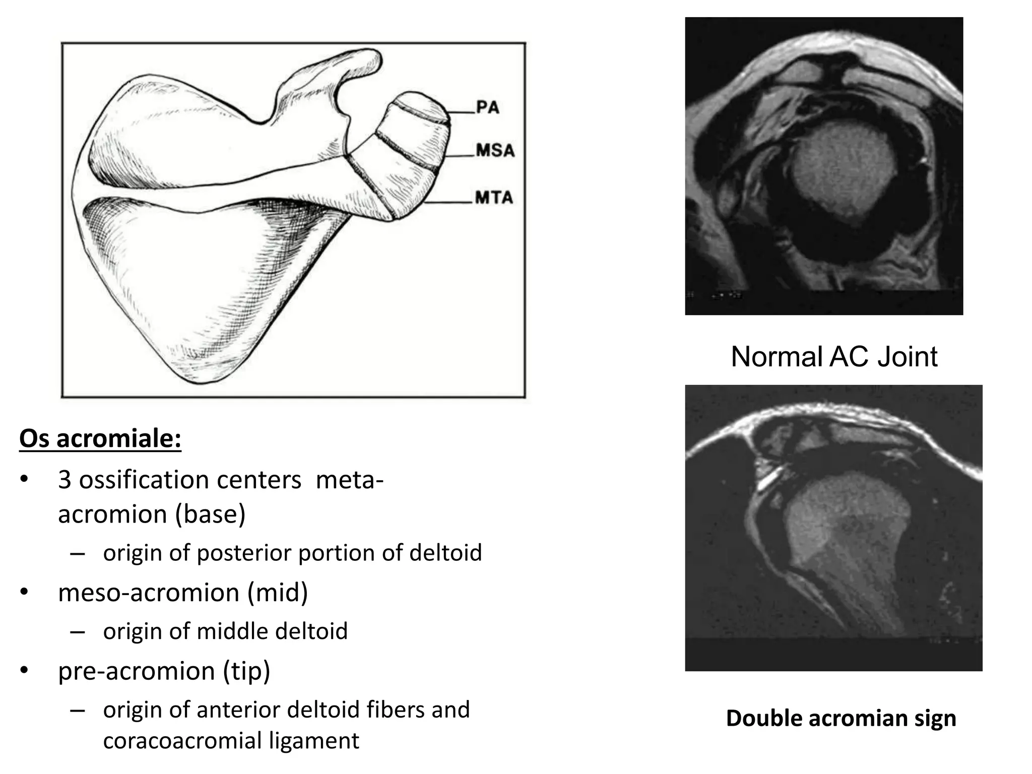 Mri shoulder joint with common pathologies | PPTX