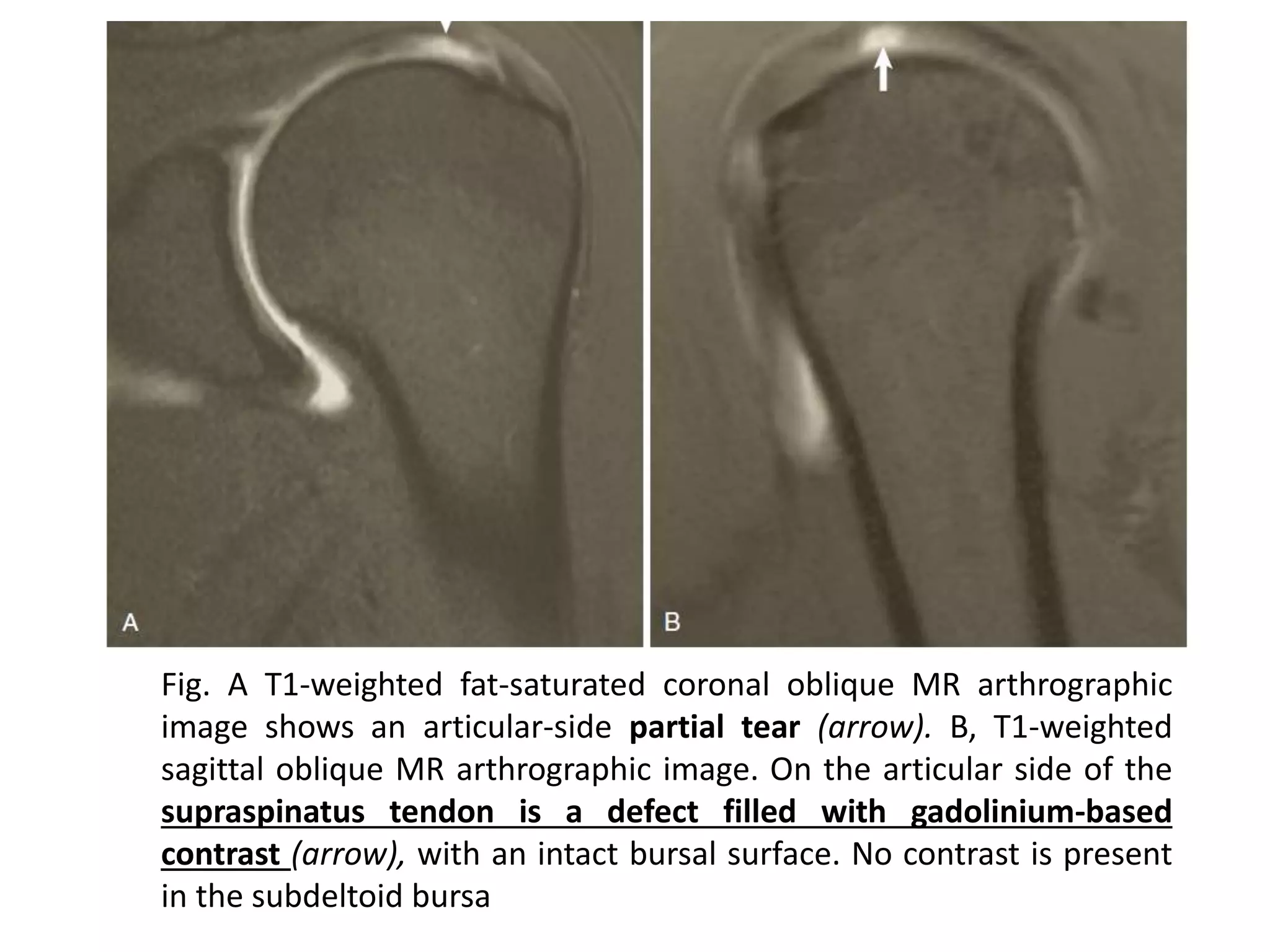Mri shoulder joint with common pathologies | PPTX