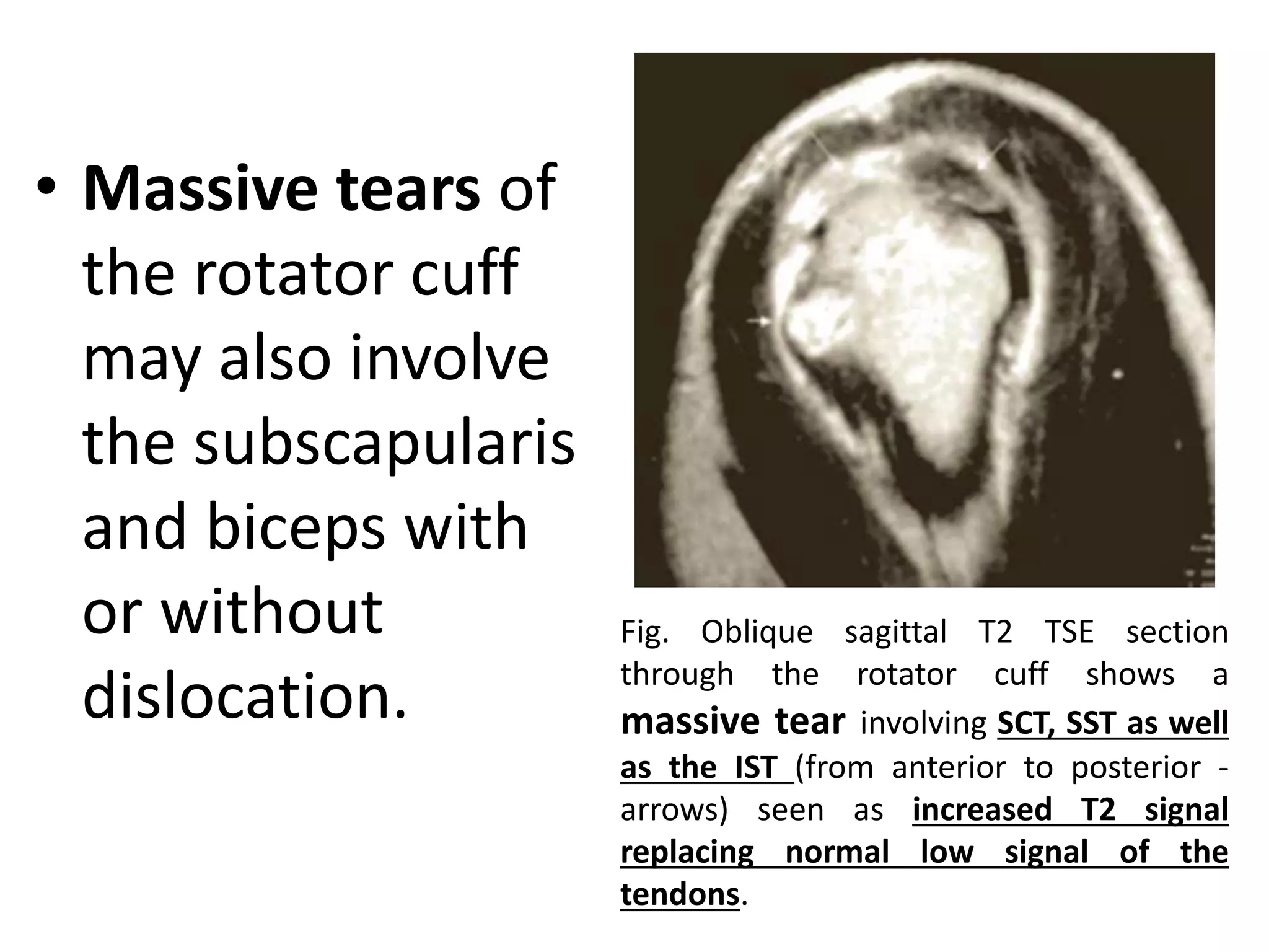 Mri shoulder joint with common pathologies | PPTX