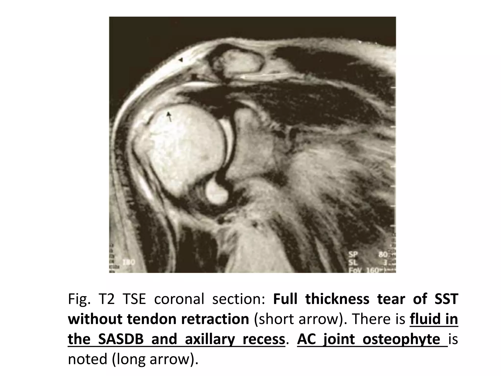 Mri shoulder joint with common pathologies | PPTX