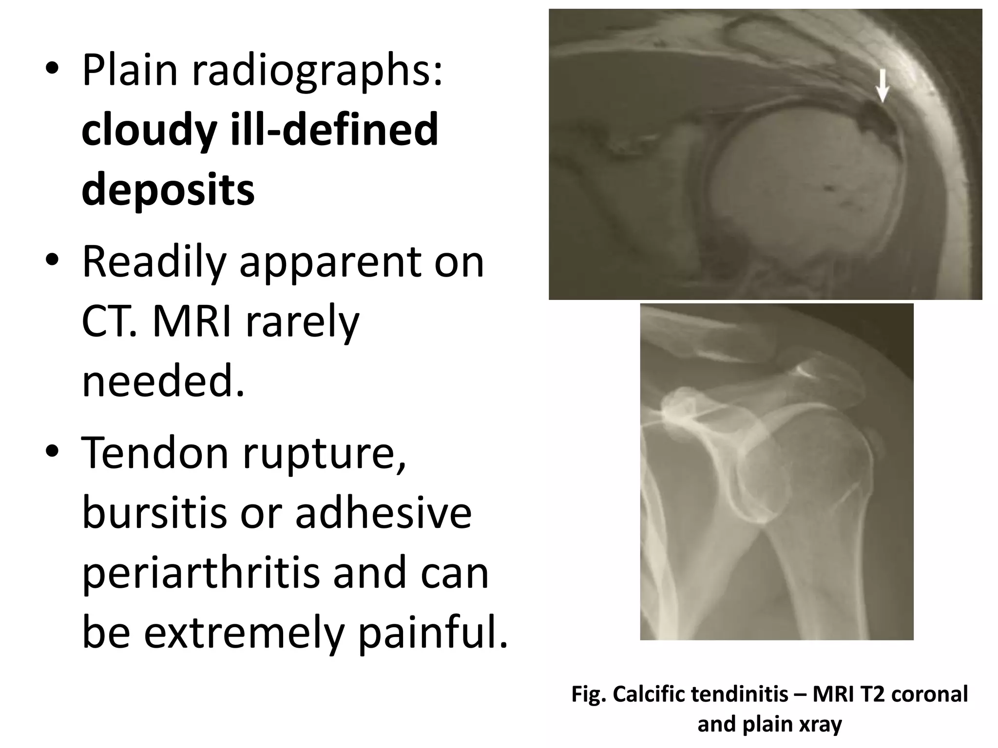 Mri shoulder joint with common pathologies | PPTX