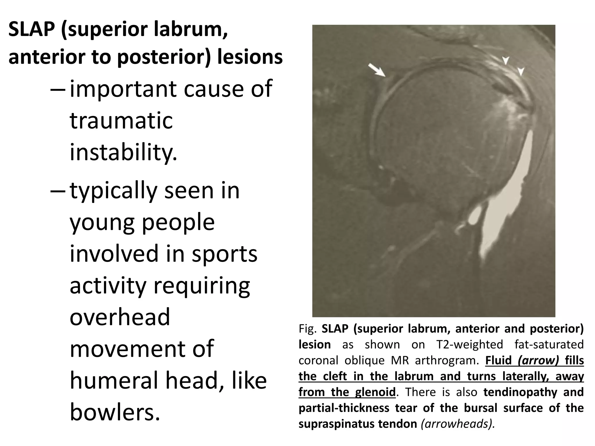 Mri shoulder joint with common pathologies | PPTX