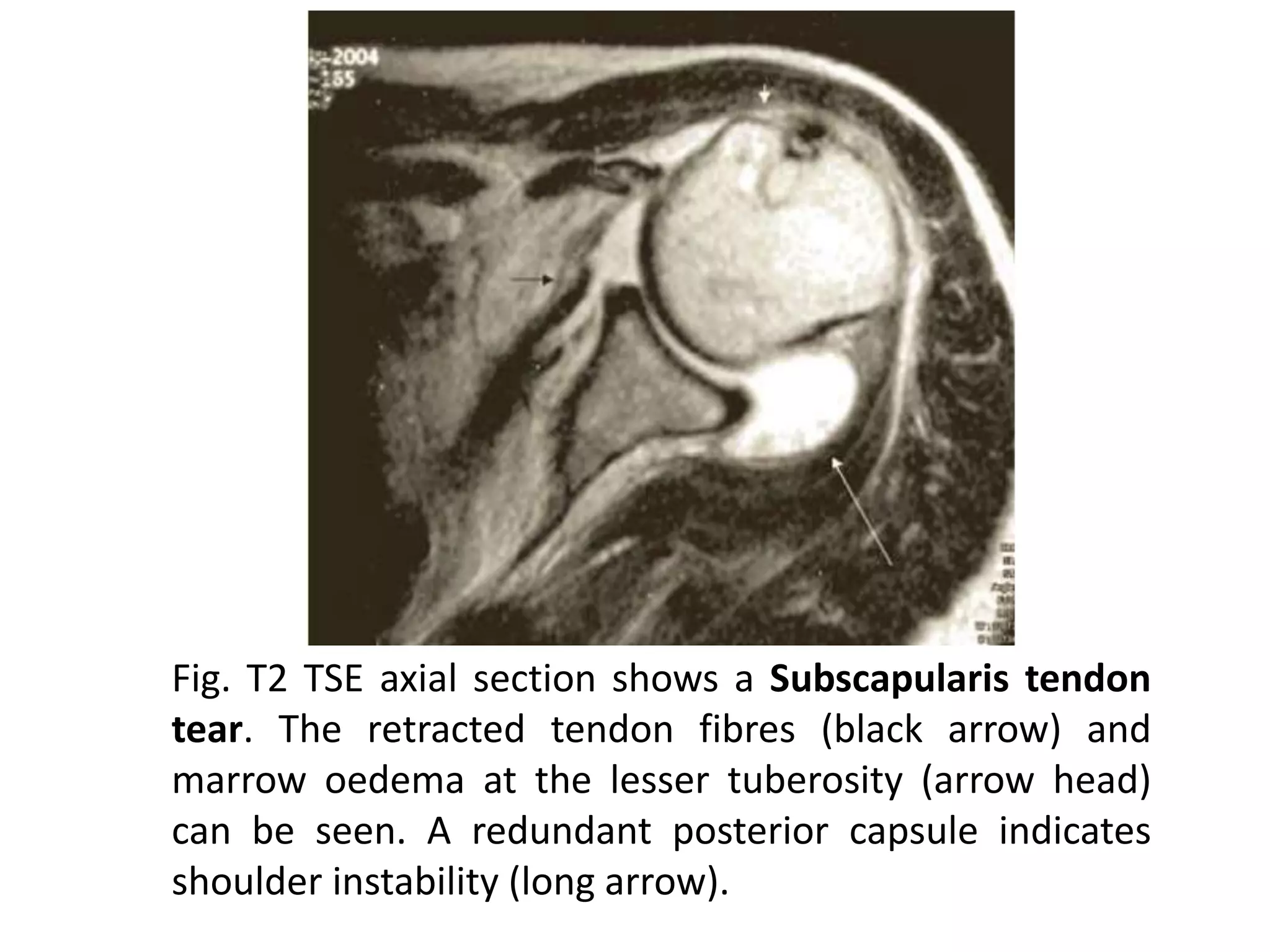 Mri shoulder joint with common pathologies | PPTX