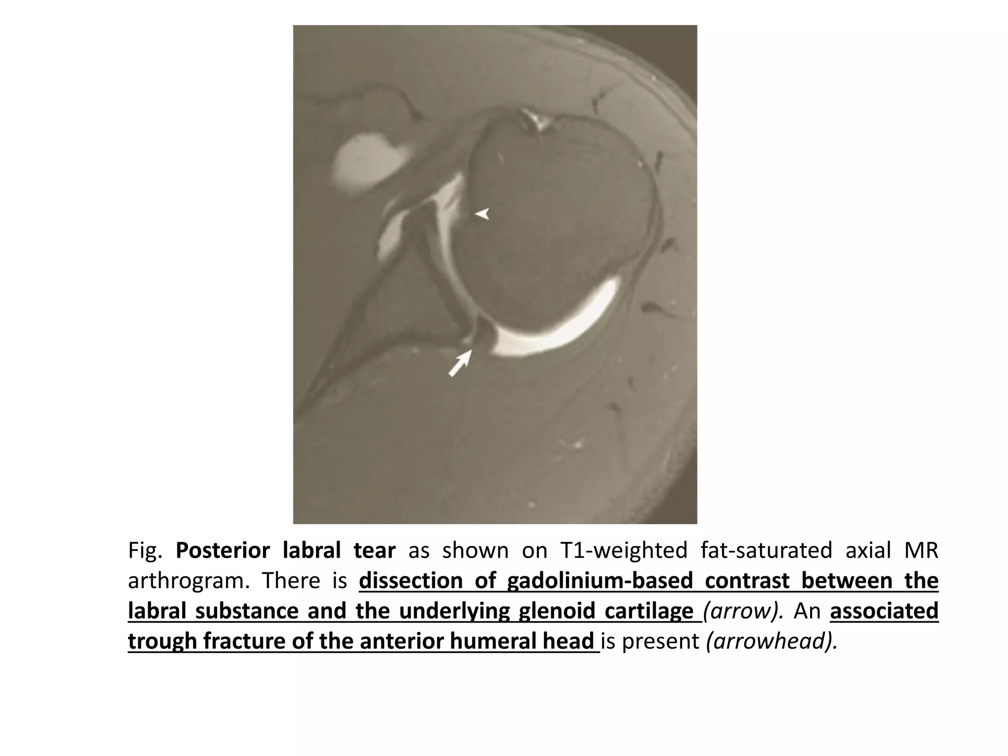Mri shoulder joint with common pathologies | PPTX