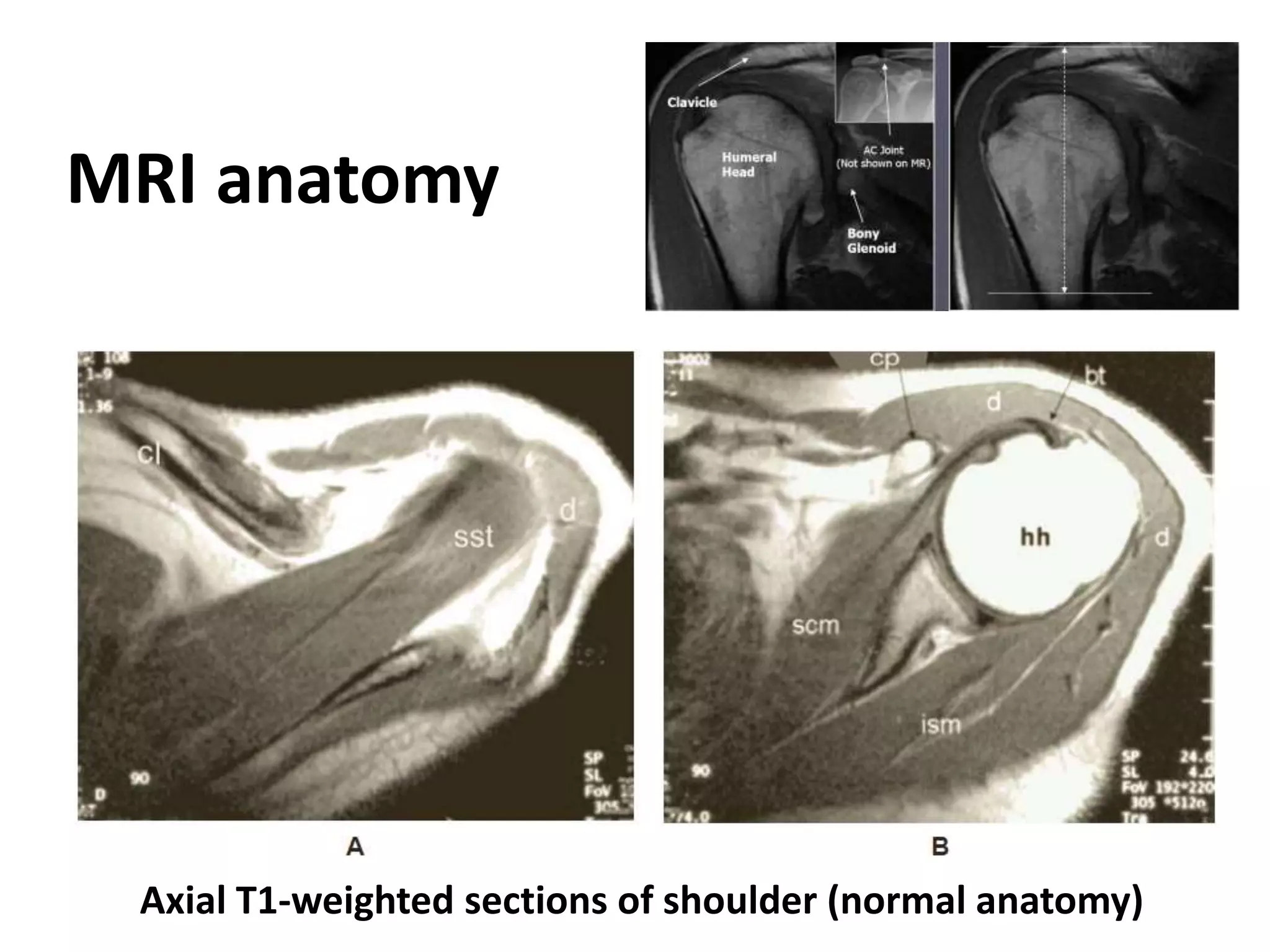 Mri shoulder joint with common pathologies | PPTX