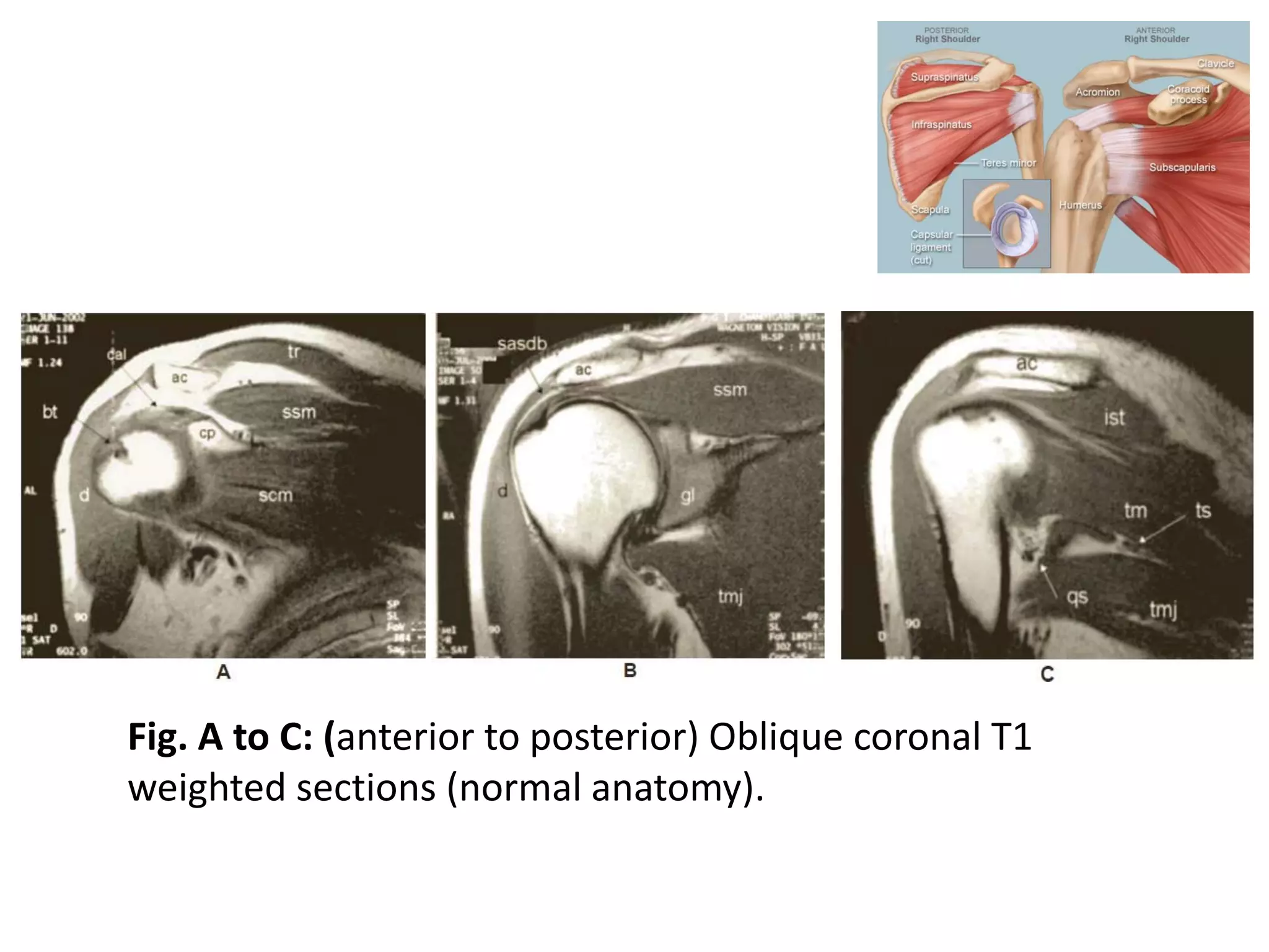 Mri shoulder joint with common pathologies | PPTX