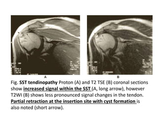Mri shoulder joint with common pathologies | PPTX