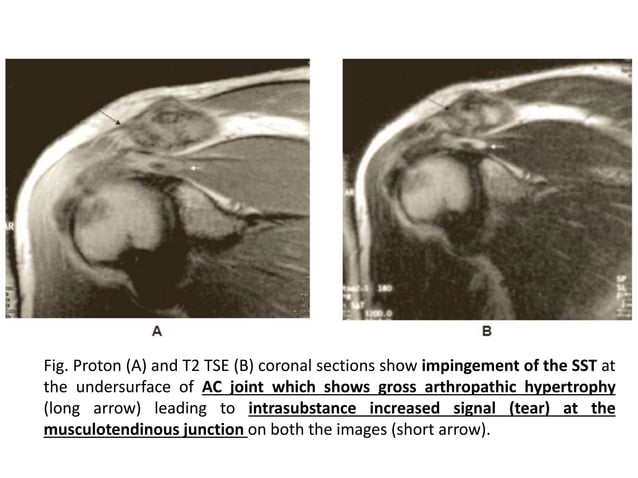 Mri shoulder joint with common pathologies | PPTX | Death, Injury, or ...