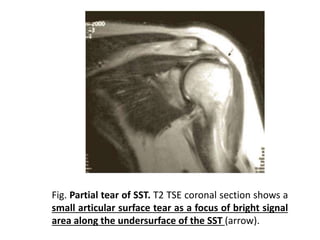 Mri shoulder joint with common pathologies | PPTX
