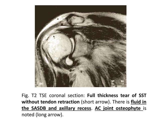Mri shoulder joint with common pathologies | PPTX | Death, Injury, or ...