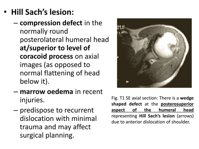 Mri shoulder joint with common pathologies | PPTX | Death, Injury, or ...