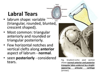 Mri shoulder joint with common pathologies | PPTX