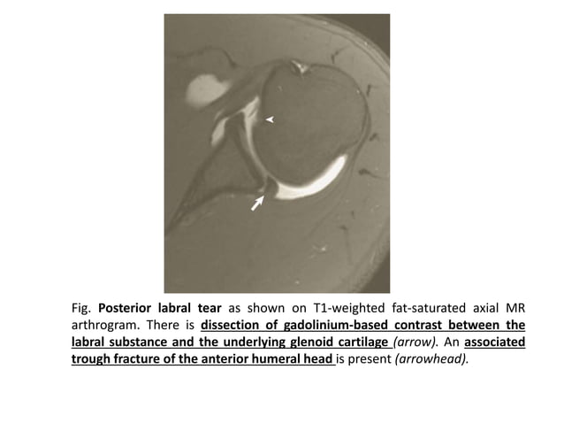 Mri shoulder joint with common pathologies | PPTX | Death, Injury, or ...