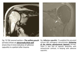 Mri shoulder joint with common pathologies | PPTX