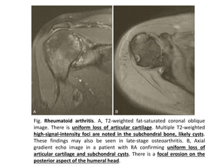 Mri shoulder joint with common pathologies | PPTX