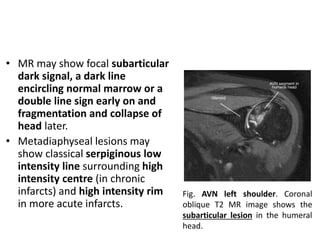 Mri shoulder joint with common pathologies | PPTX