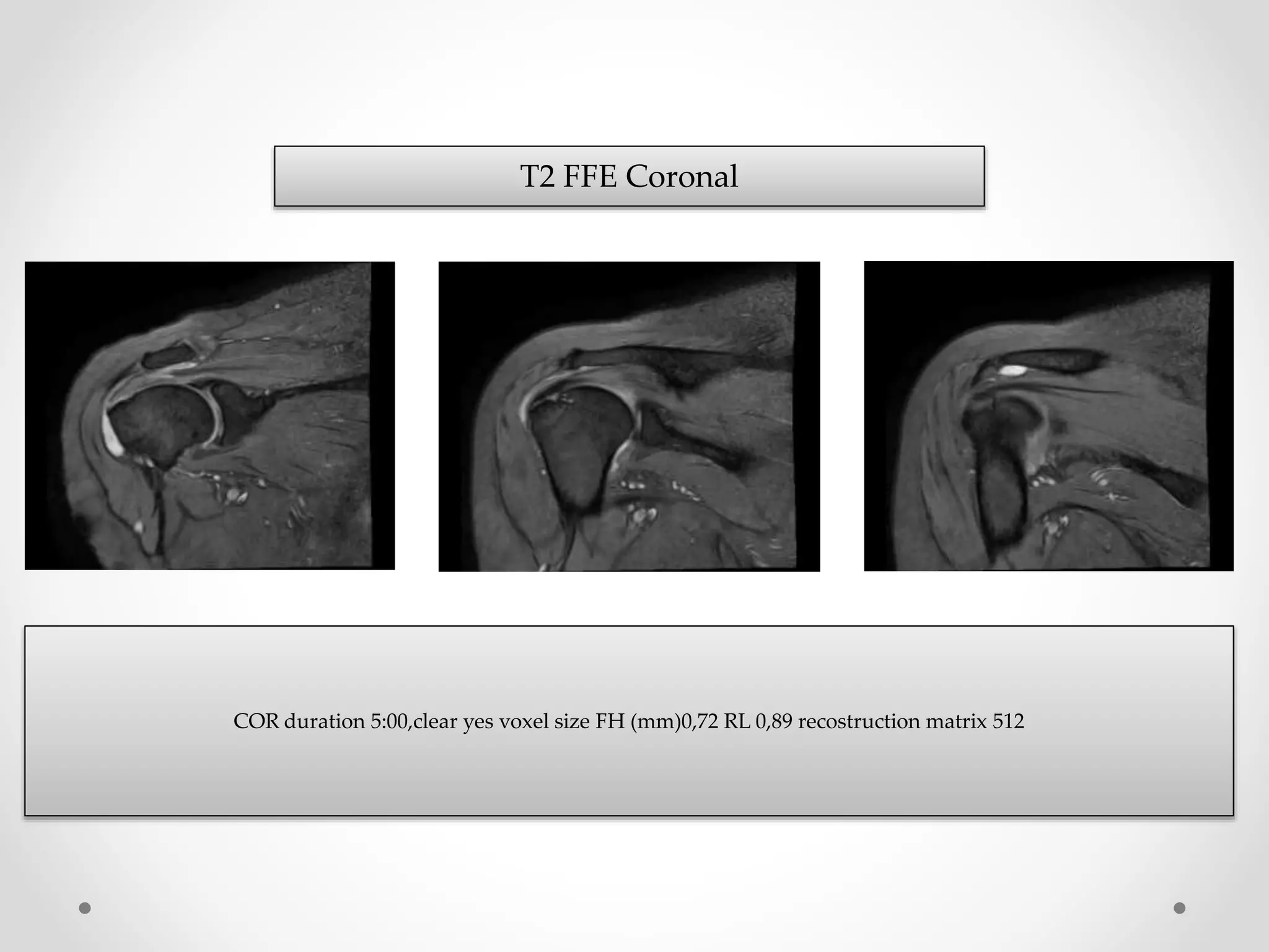 Mri shoulder coil flex 1 channel open MRI,executed by Giuseppe ...