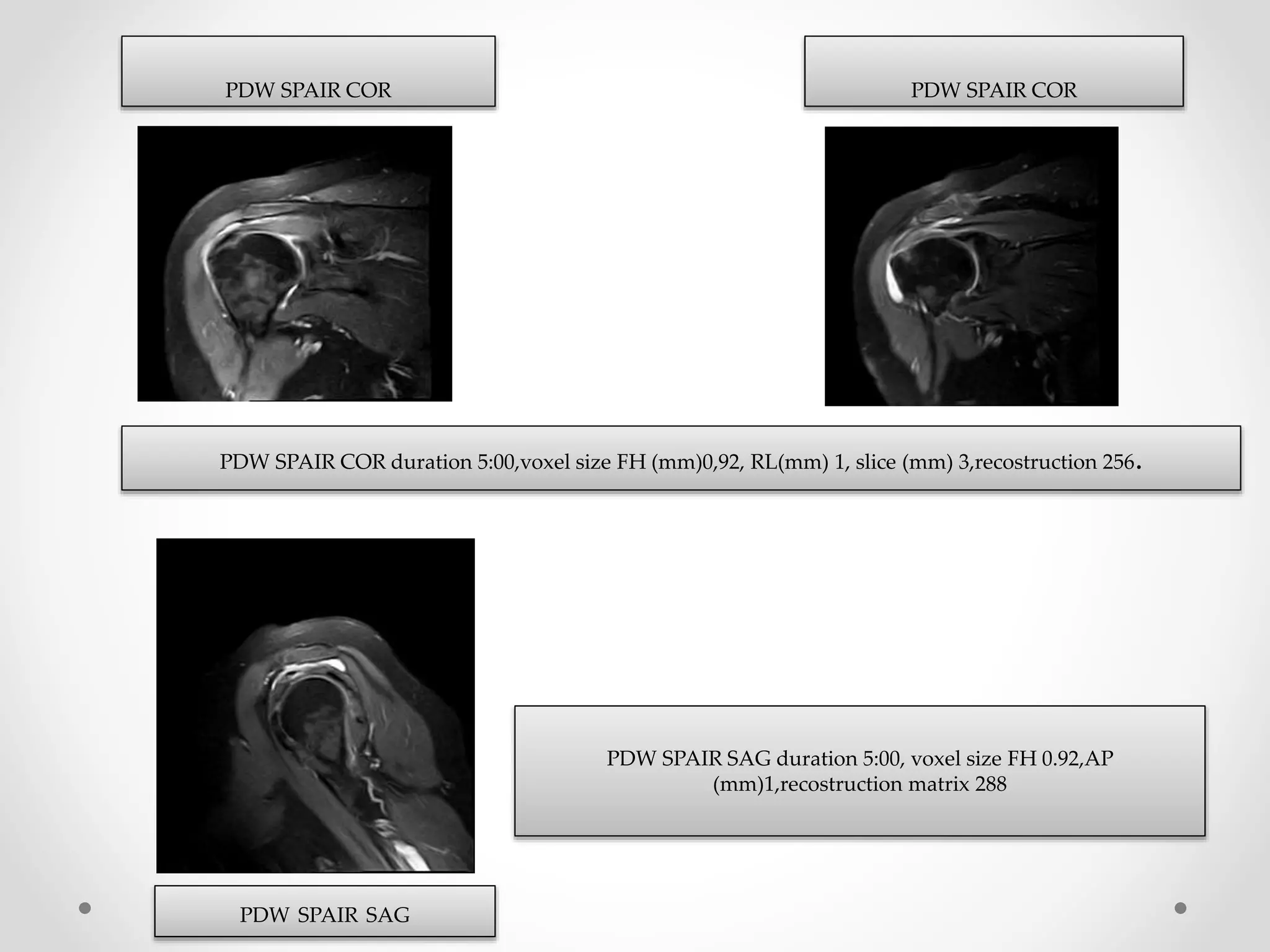 Mri shoulder coil flex 1 channel open MRI,executed by Giuseppe ...