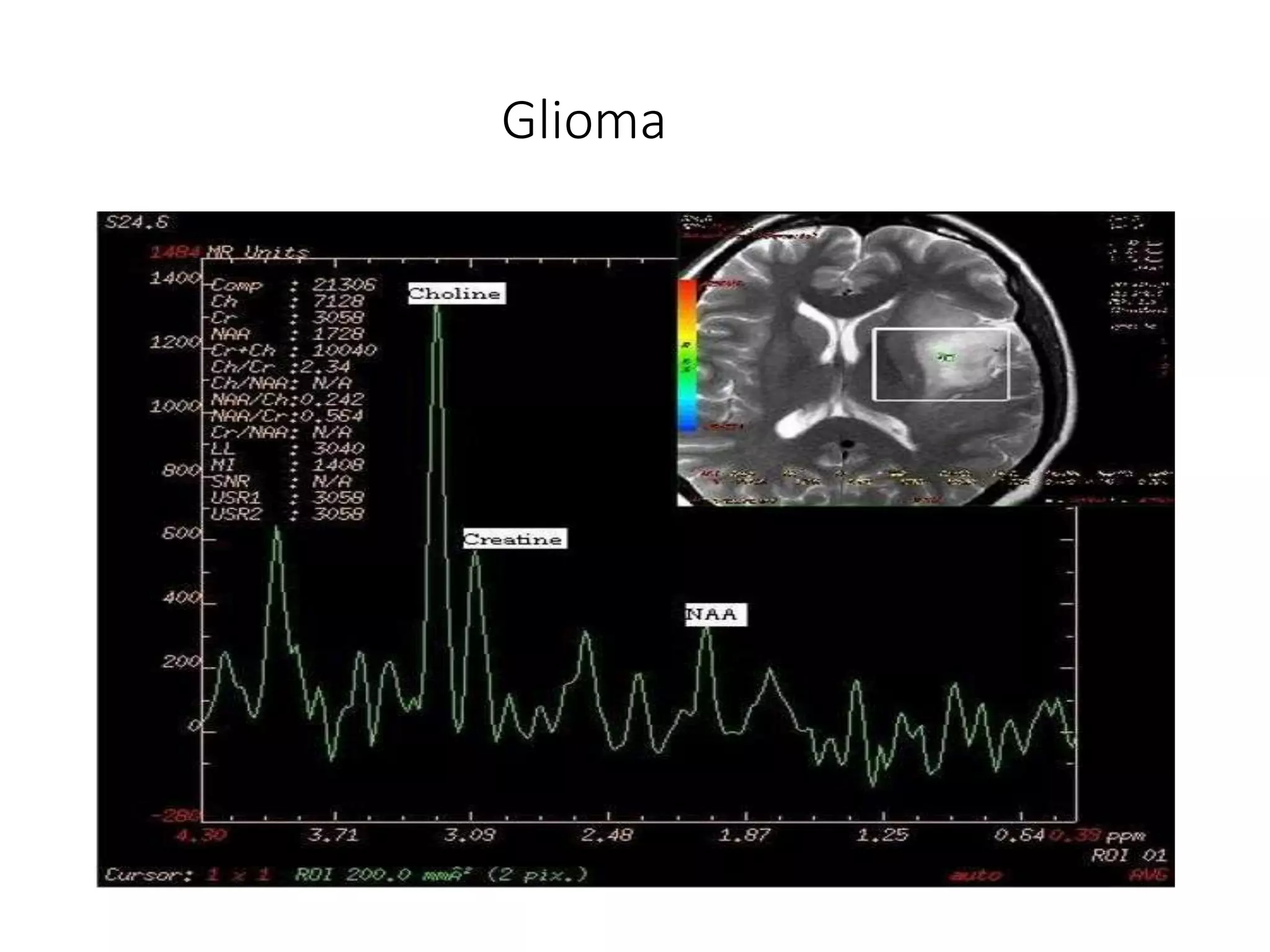 MRI spectroscopy- Its Application, Principle & Techniques | PPTX