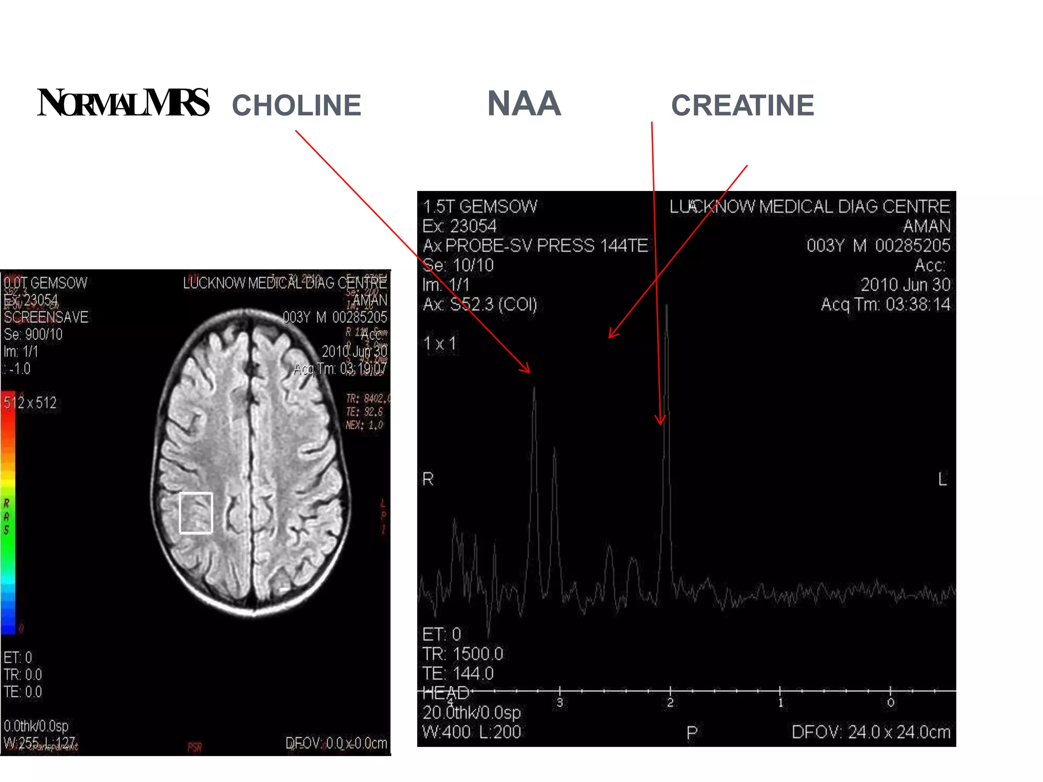 MRI spectroscopy- Its Application, Principle & Techniques | PPTX ...
