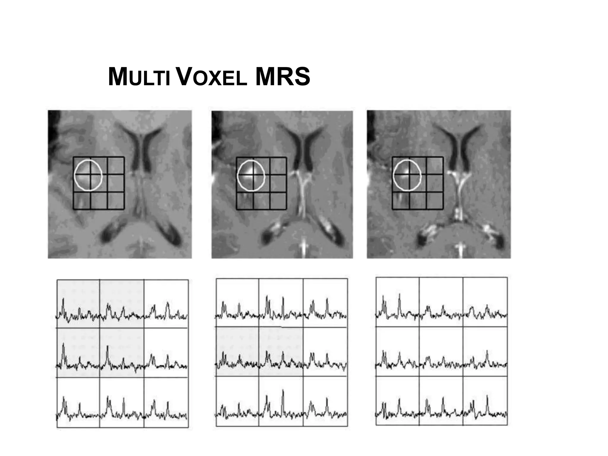 MRI spectroscopy- Its Application, Principle & Techniques | PPTX