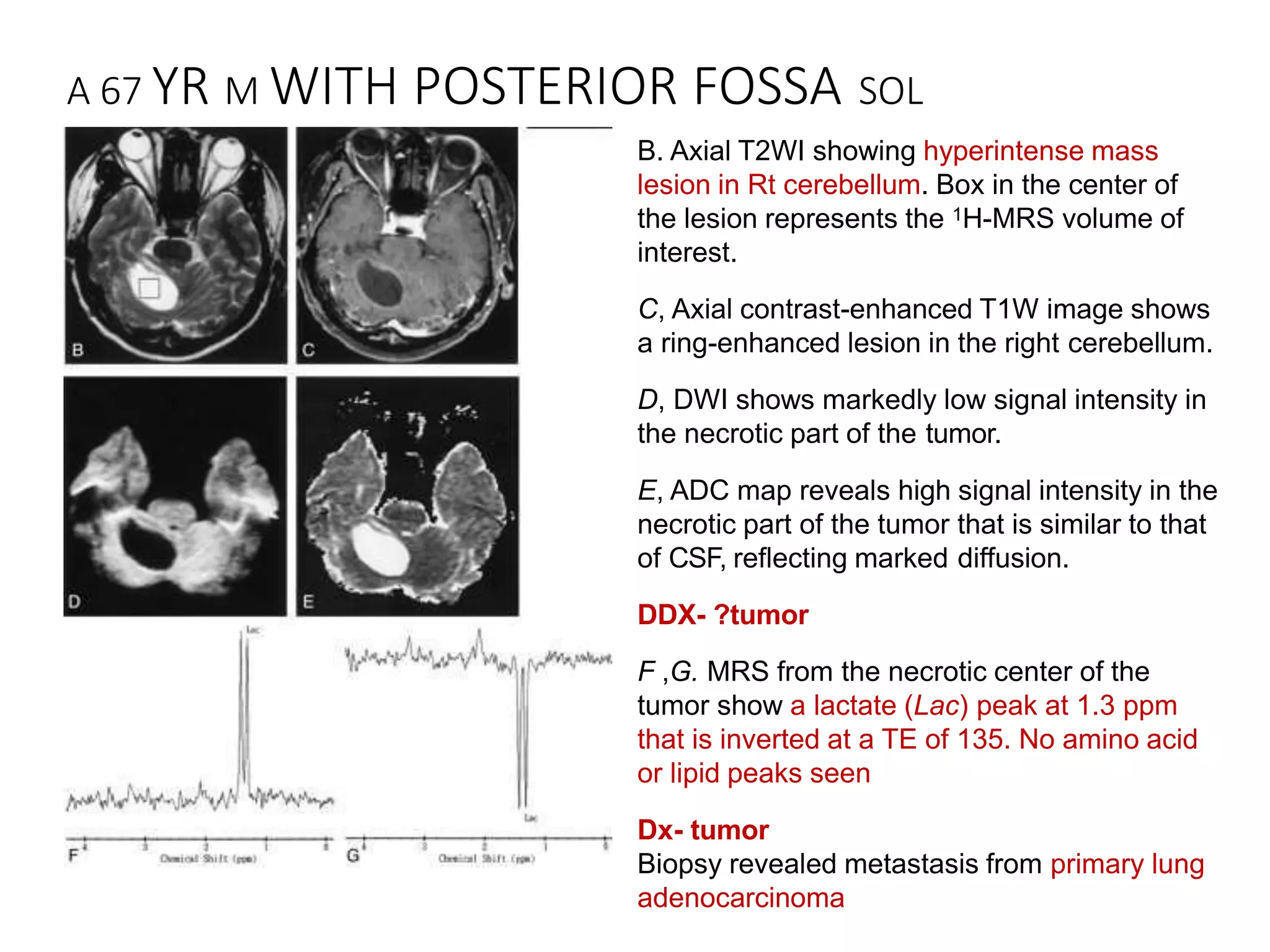 MRI spectroscopy- Its Application, Principle & Techniques | PPTX