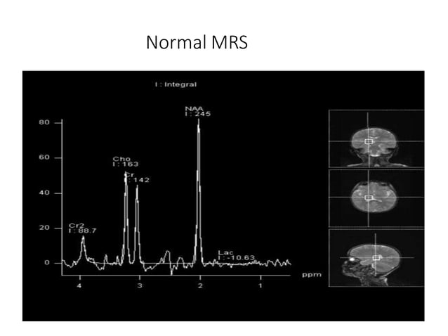 MRI spectroscopy- Its Application, Principle & Techniques | PPTX ...