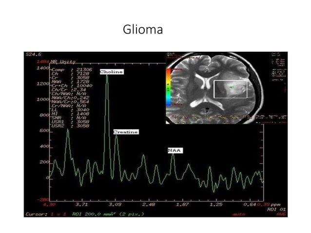 MRI spectroscopy- Its Application, Principle & Techniques | PPTX ...