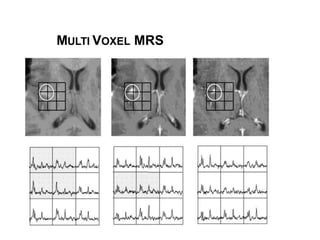 MRI spectroscopy- Its Application, Principle & Techniques | PPTX